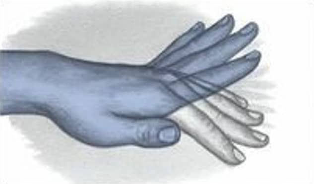 Asterixis| ULY CLINIC